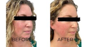 What is a Thread Lift? - Procedure, Benefits, Costs & Aftercare